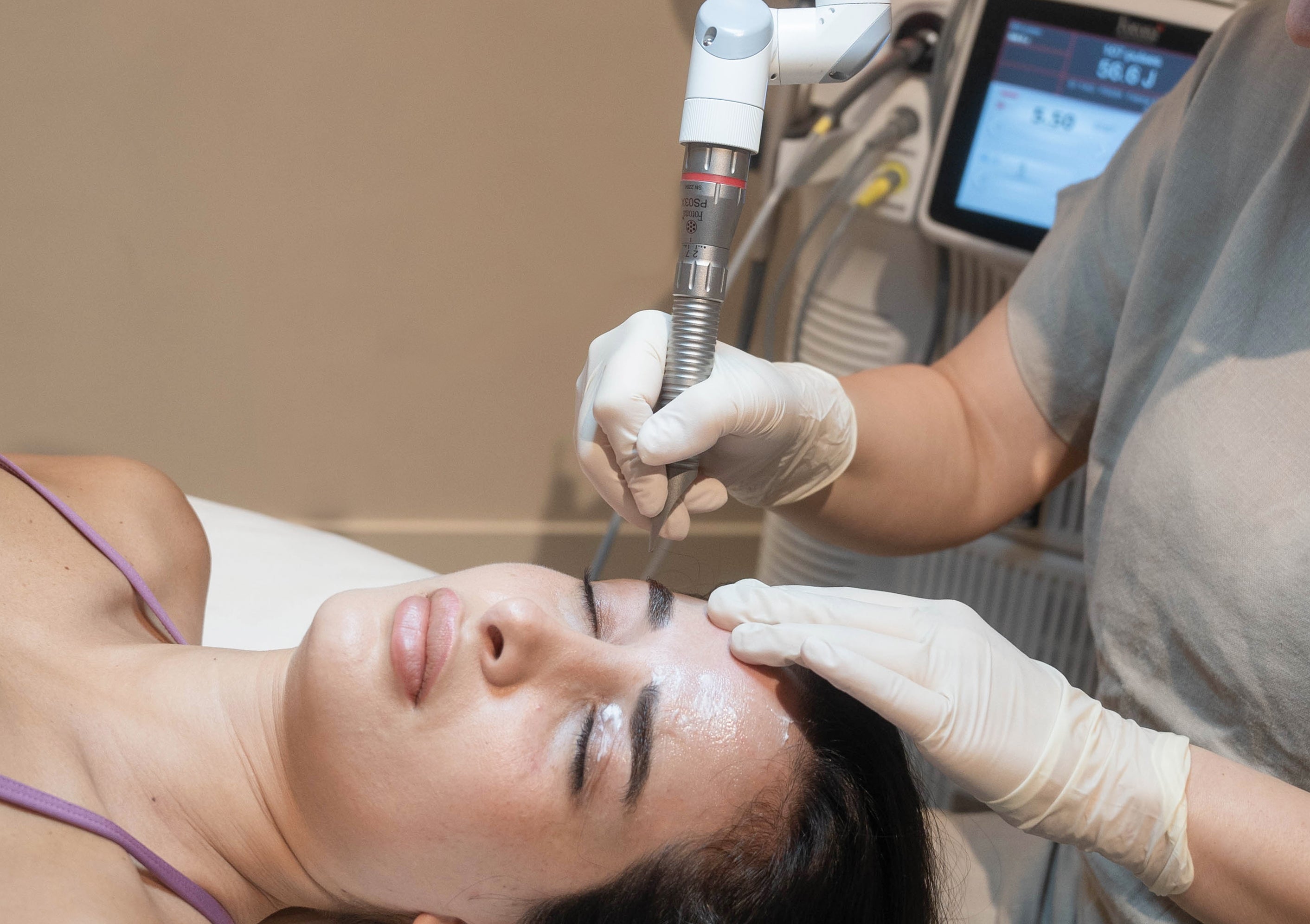 Fotona Vector Lift | Smooth Eye Laser Treatment with Fotona